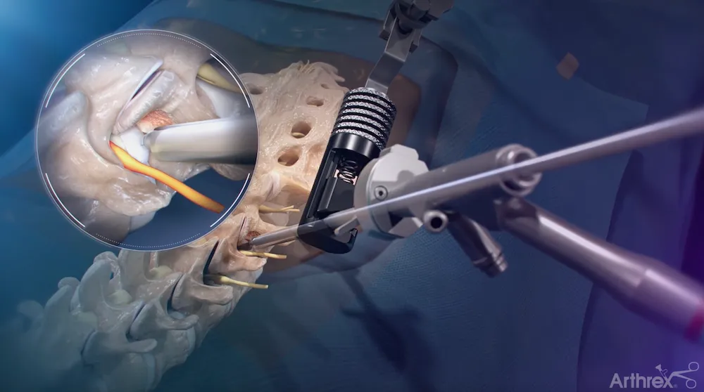 Endoscopic Spine Surgery Is Here | Arthrex Endoscopic Spine